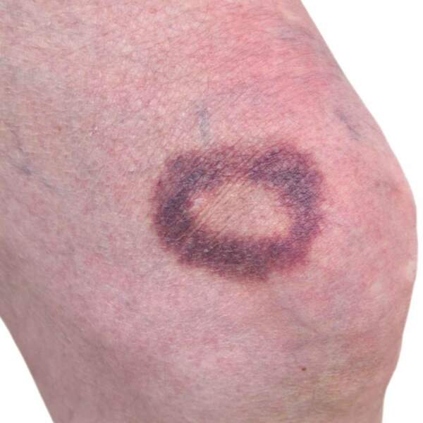 What Is A Hematoma Symptoms, Diagnosis and Treatment