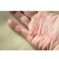 A Comprehensive Guide to Dupuytren's Contracture
