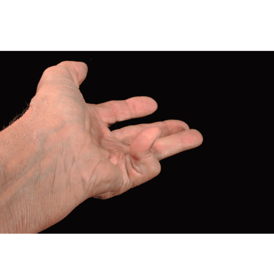 A Comprehensive Guide to Dupuytren's Contracture
