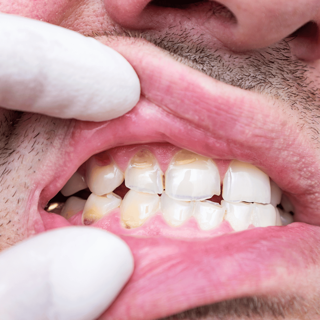 8 Natural ways to relieve teeth grinding and chronic neck pain